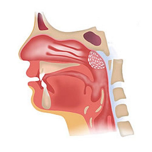 HIPERTROFIA DE ADENÓIDE – Clínica Dr. Carlos Navarro