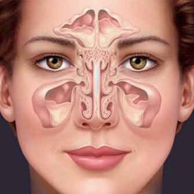 SINUSITES – Clínica Dr. Carlos Navarro